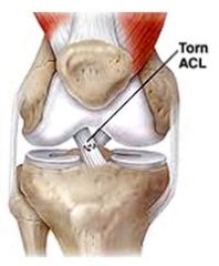 ACL Surgery - ProOrtho Orthopedics Sport, Joints & Spine | Proliance ...