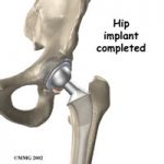Hip Replacement - ProOrtho Orthopedics Sport, Joints & Spine ...