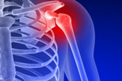 What Is Acromioclavicular Arthritis (AC Joint Arthritis)?